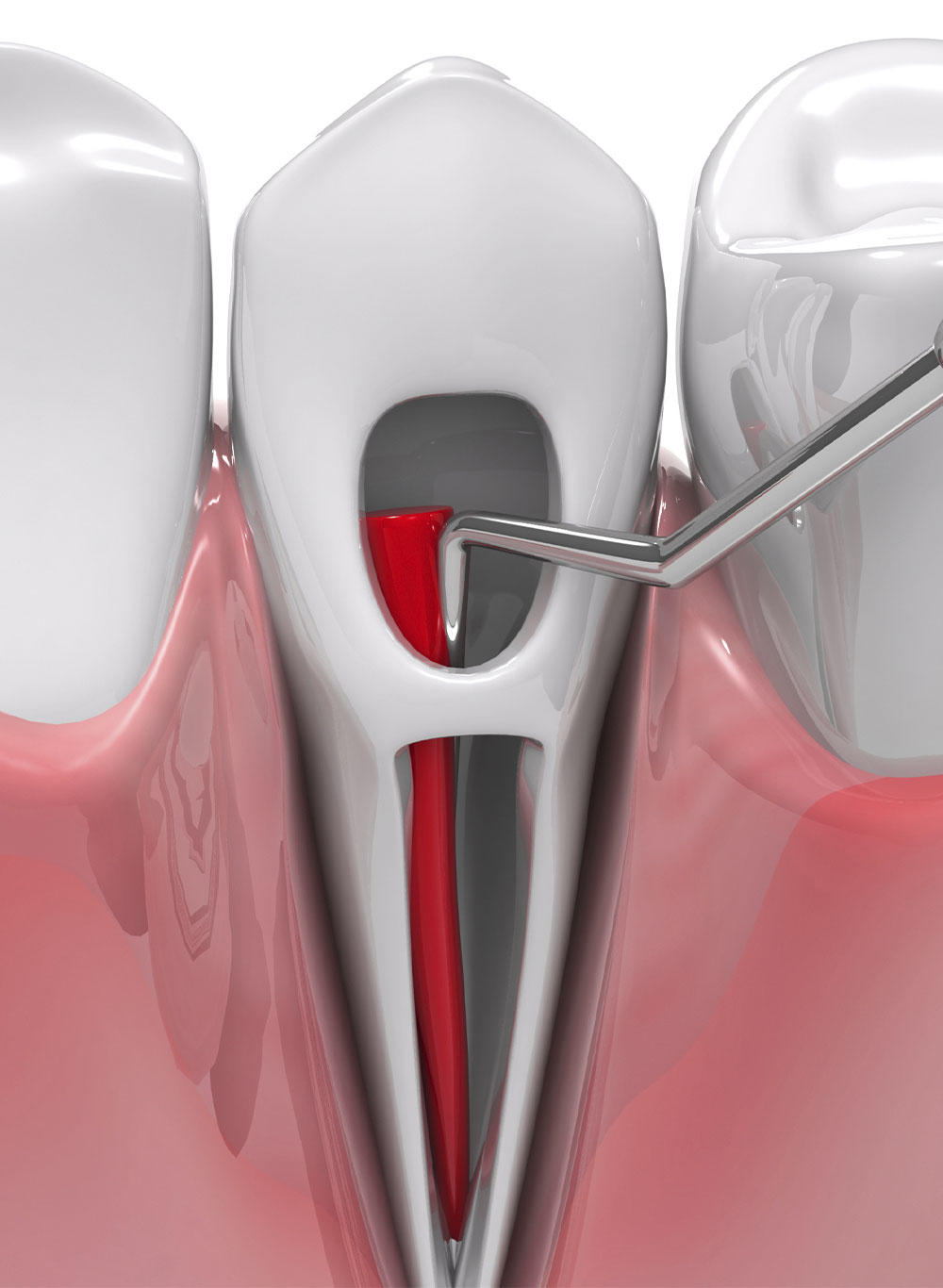 Canal Radicular Da Coroa Do Dente Endodontia | Tratamento De Canal